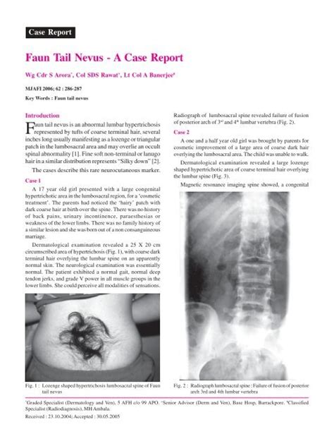 Faun Tail Nevus A Case Report Medind