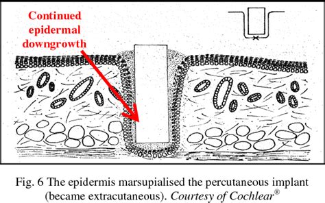 Figure 6 From Implantable Bone Conduction Hearing Aid Baha System