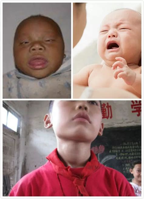 【全国碘缺乏病日】碘多？碘少？缺乏和过量危害都很大！碘石成金！碘到为止！