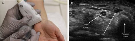 Peripheral Nerve Blocks At The Wrist A Median Nerve Block B Ulnar