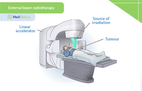 Radiation Therapy For Metastases Medical Tourism With Mediglobus The