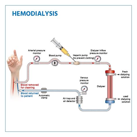Hemodiálisis Pasos Procedimiento Y Recuperación
