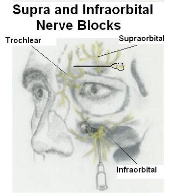 Quick Fix For Headaches Repeated Nerve Supraorbital Infraorbital