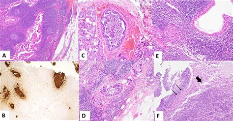 A Nests Of Sdc Within The Lymph Node B Cam5 2 Highlights The Download Scientific Diagram