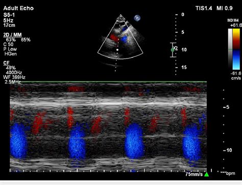 Color Doppler On Motion Mode Section Across The Descending Aorta Download Scientific Diagram