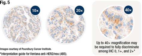 Scoring Her2 Expression Across The Full Spectrum Cap Today