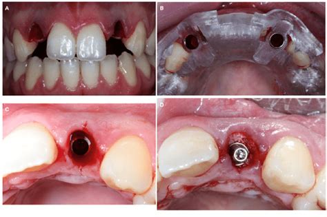 A Preservation Of Architecture The Alveolar Socket After The Download Scientific Diagram