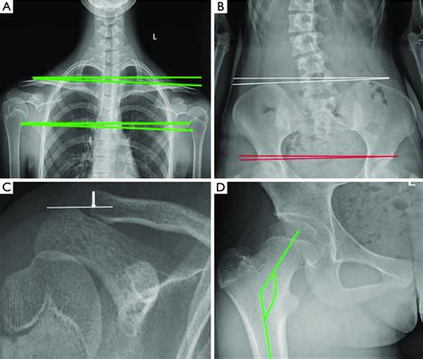 Measurement Of The Ca Glenoid Inclination Io Acetabular Inclination