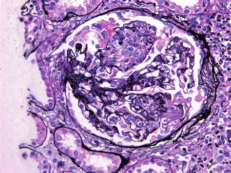 Representative Glomerulus From Case 2 There Is Segmental Endocapillary Download Scientific