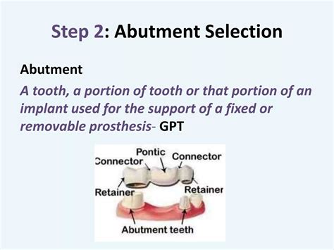Design Of A Fixed Partial Denture With Abutment Tooth Preparation Pptx