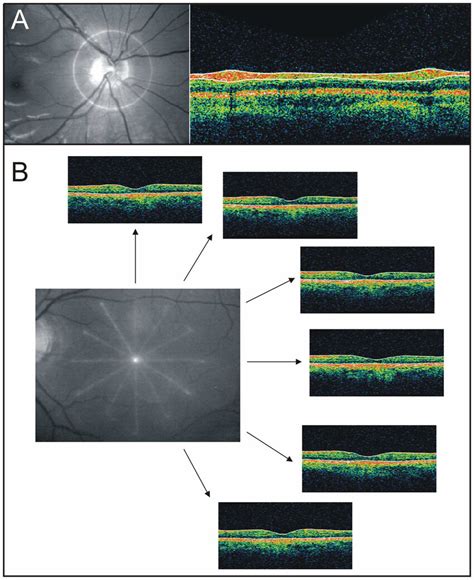 A Location Of Td Oct Peripapillary Scan Shown On Fundus Photograph