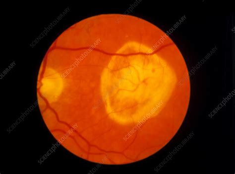 Ophthalmoscopy Of Disciform Macula Degeneration Stock Image M155