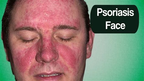 Plaque Psoriasis Face At Patricia Petrie Blog