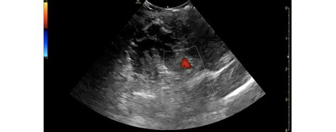 Guide On Pocus For Pta — Usf Emergency Medicine