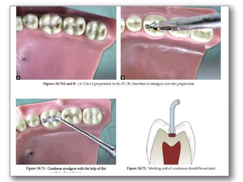 Class 2 Amalgam Restoration Pptx