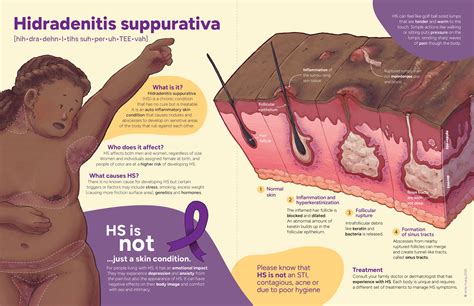 Pathological Illustrationhidradenitis Suppurativa — Emily Huang