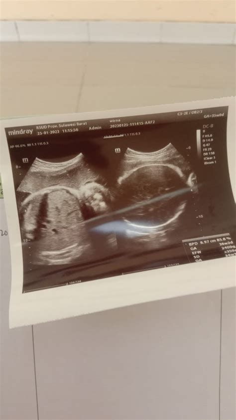 Tentang Foto Usg Hellosehat