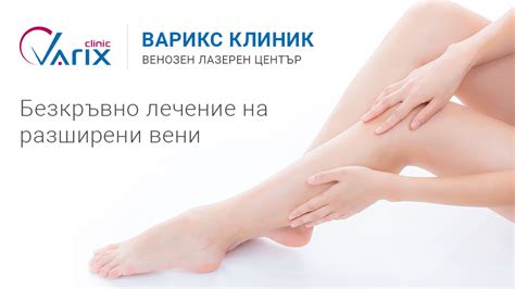 Варикс Клиник Лечение на разширени вени
