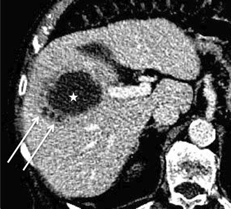 Liver Abscess With Spontaneous Drainage In The Peritoneal Cavity