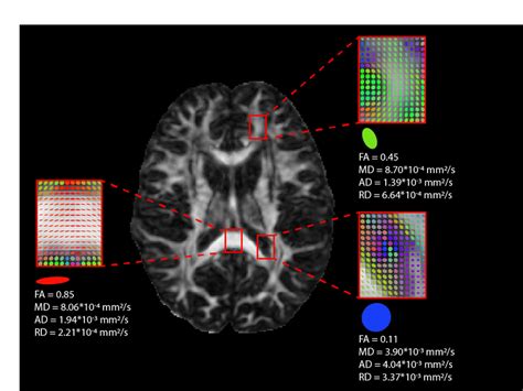 Tensor Descriptions Of Diffusion Are Shown In A Healthy Human Brain Download Scientific Diagram