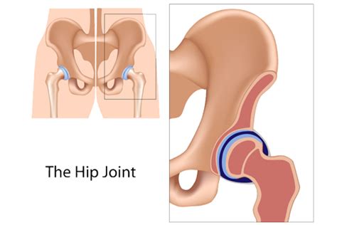 Dmv Orthopedics What Is Hip Pointer What Are Symptoms