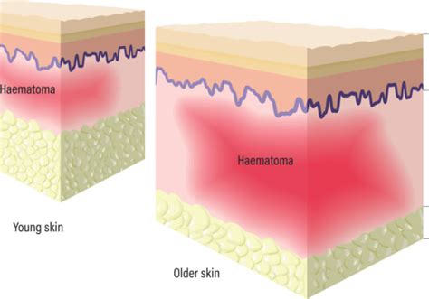 Understanding Exudate What It Is And What It Means