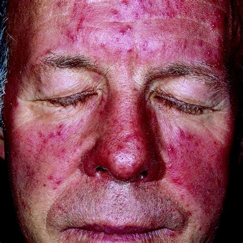 Atopic Dermatitis Note Erythema And Scaling Of Flexural Areas Download Scientific Diagram