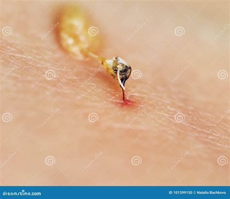 La Picadura De Abeja Aguda Perforó Doloroso La Piel E Inyectó Los Pois