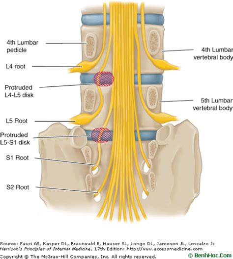 S Spinal Nerve Compression Mapageprek