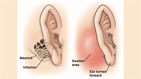 Treatment For Mastoiditis In Homeopathy Dr Bhatias Asha Homeopathy Center