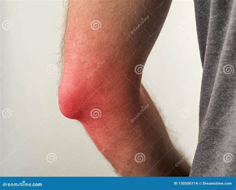 Swollen Fluid Filled Lump On Elbow At Ethan Sines Blog