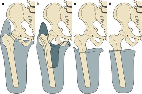 Ischial Containment Socket Workshop المؤسسة الهندسية Amman 13 September 2025 Allevents