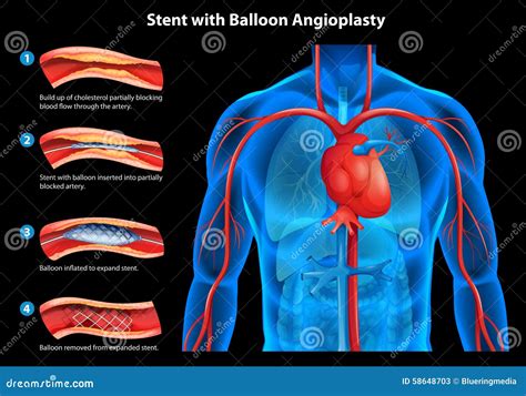 Stent With Balloon Angioplasty Stock Vector Illustration Of Graphic