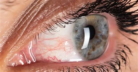 Anterior Uveitis Understanding The Condition