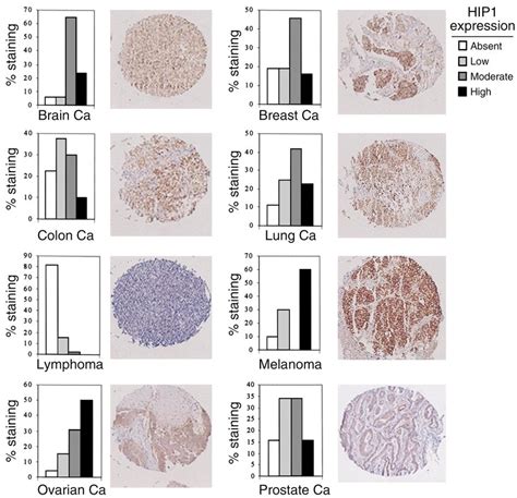 Immunohistochemical Analysis Of The Multitumor Tissue Microarray Tarp1