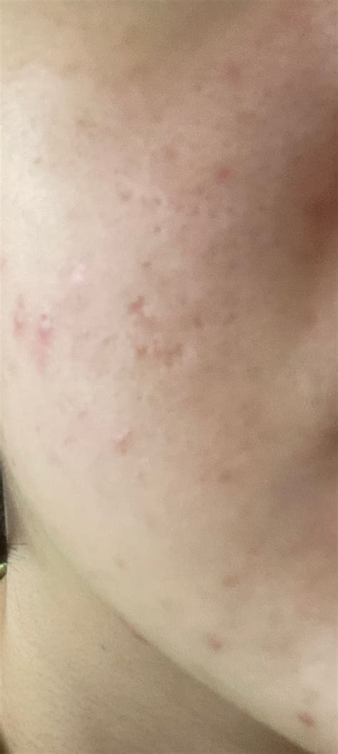 쥬베룩vs프락셀 지식in