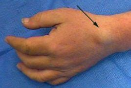 Effective Ganglion Cyst Treatment Nebraska Hand And Shoulder Institute