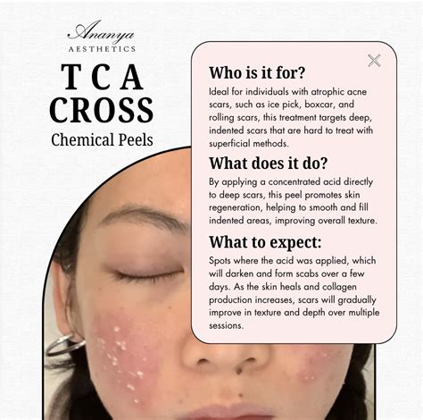 Best 12 Chemical Peel For Treating Deep Stubborn Acne Scars Tca Cross