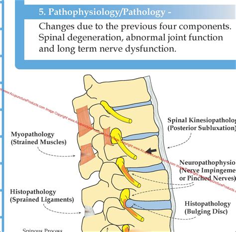 Vertebral Subluxation Complex Spinal Degeneration Poster Cervical