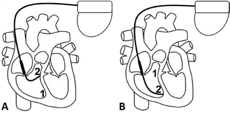 The Scheme Of Defibrillation Lead Implantation Technique In The 1st Download Scientific Diagram