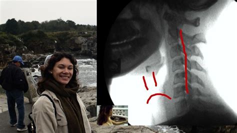 Fundraiser By Emily Barragan Help Emily Treat Her Neck Ligaments