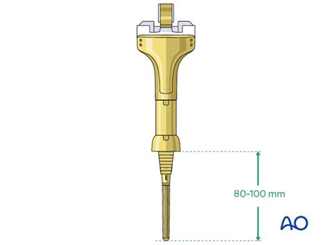 Proximal Tibia Replacement For Fracture Around A Loose Tibial Component With Poor Bone Stock