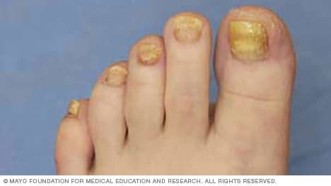 Fungal Toenail Infection Onychomycosis Symptoms Causes And Treatment