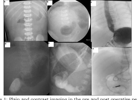 Figure 1 From Preampullary Duodenal Web Simulating Gastric Outlet Obstruction Semantic Scholar