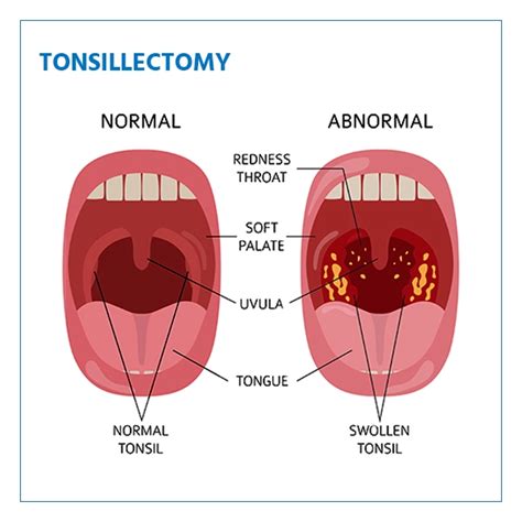 Tonsillectomy Procedure Step By Step