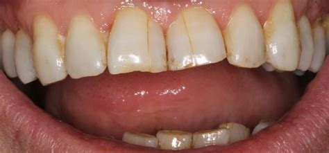 Craze Lines Teeth Symptoms Causes And Treatment Atlas Dental