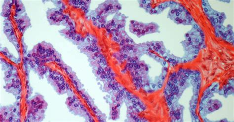 Scientists Identify A Complex Link Between Gut Bacteria And Prostate Cancer