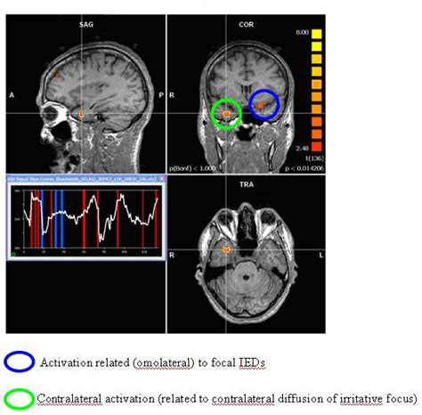 Neuroimaging Of Epilepsy Eeg Fmri In The Presurgical Evaluation Of
