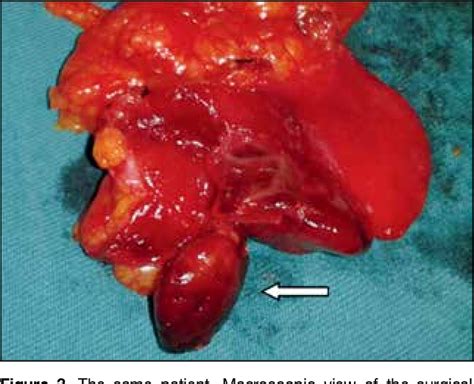 Figure 3 From Radiological Findings Of Falciform Ligament Necrosis A