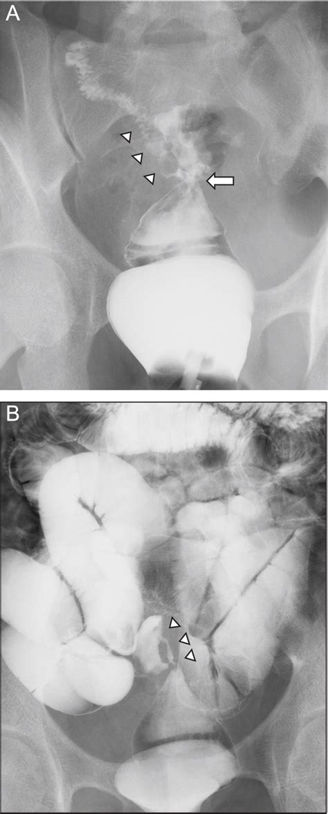 Figure 1 From Ileal Interposition Reconstruction For Ileo Rectal Fistula Following Sex